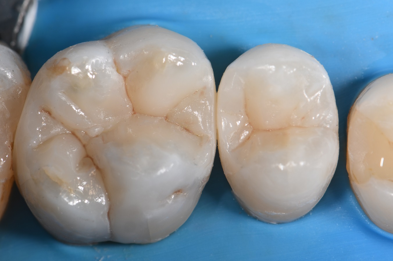 Amalgam restorations replaced with invisible composite