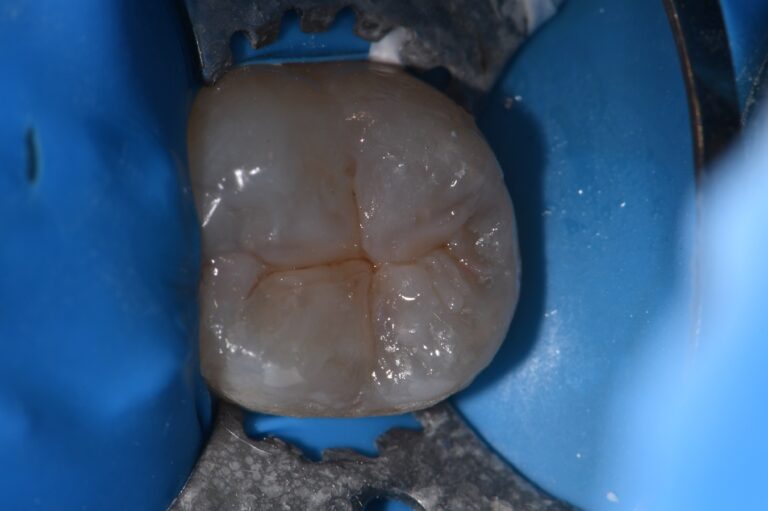 When a fissurotomy turns into caries
