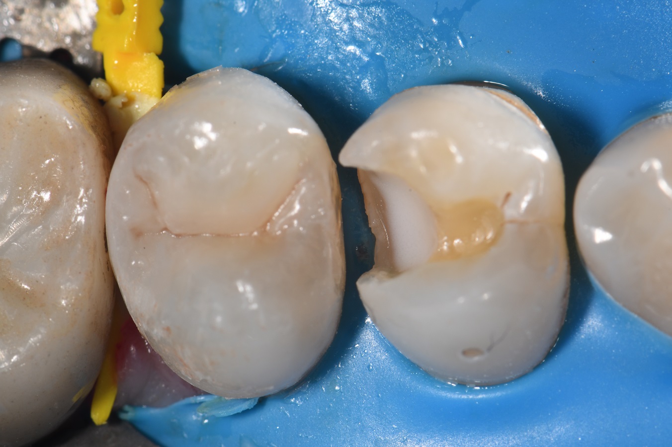 Using Garrison Strata-G over Compositight 3D Fusion