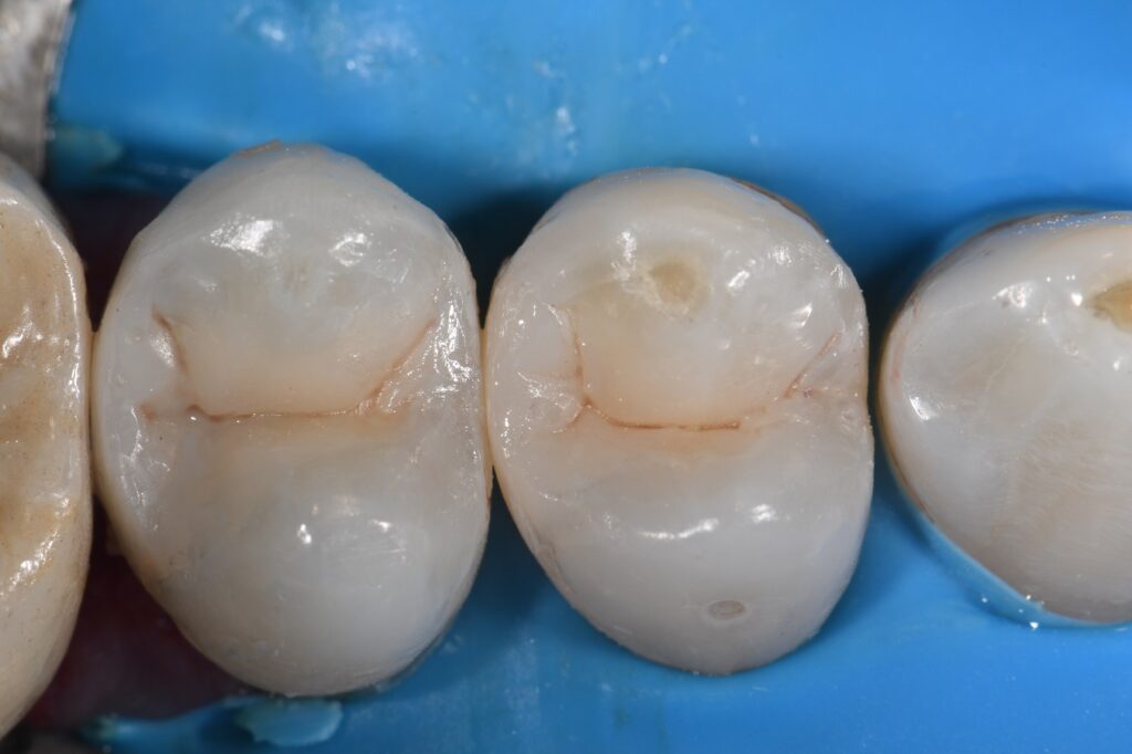 Using Garrison Strata-G over Compositight 3D Fusion
