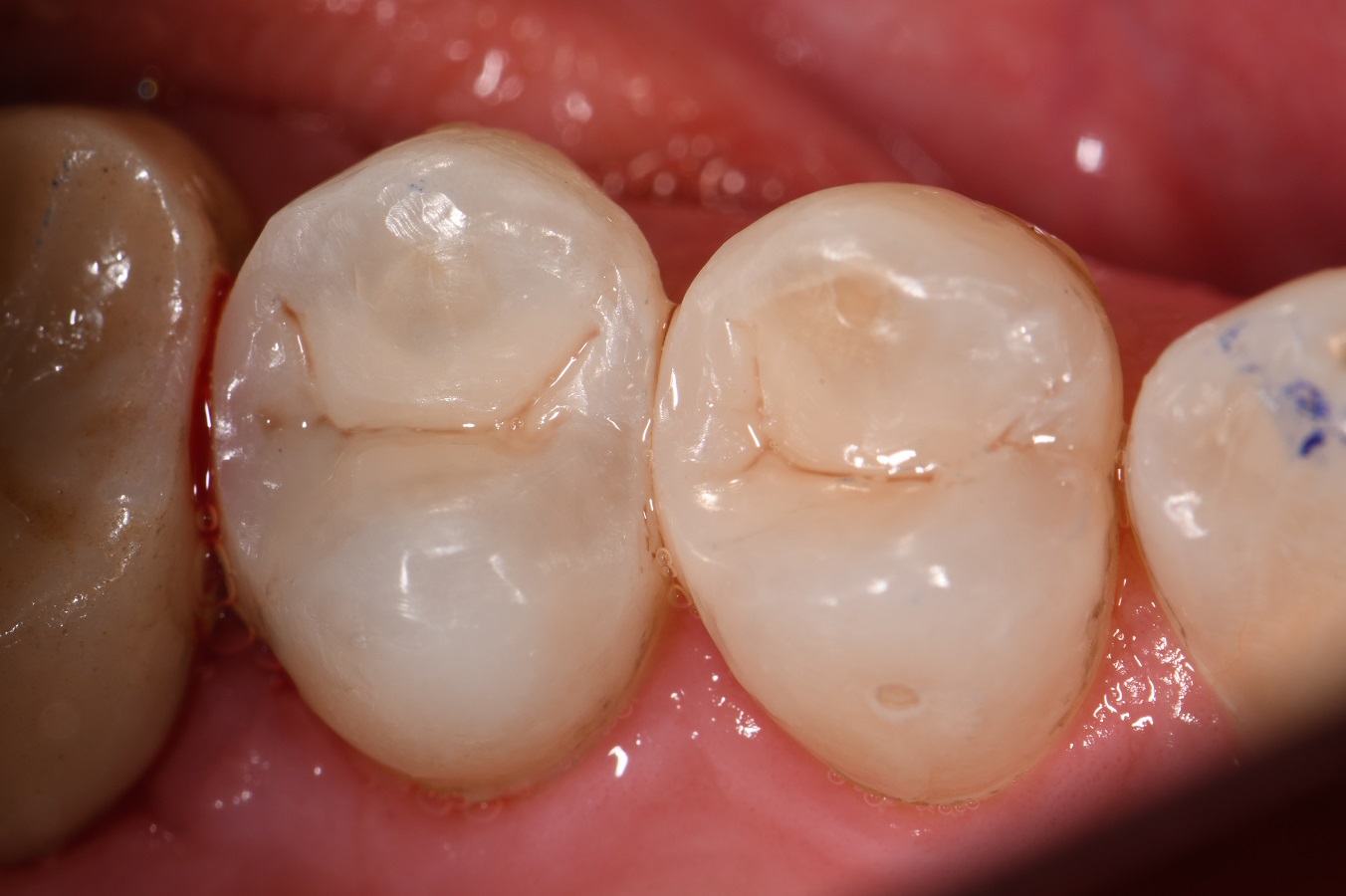 Using Garrison Strata-G over Compositight 3D Fusion