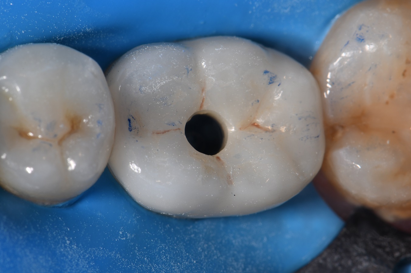 Implant Screw Access Closure using Composite Resin