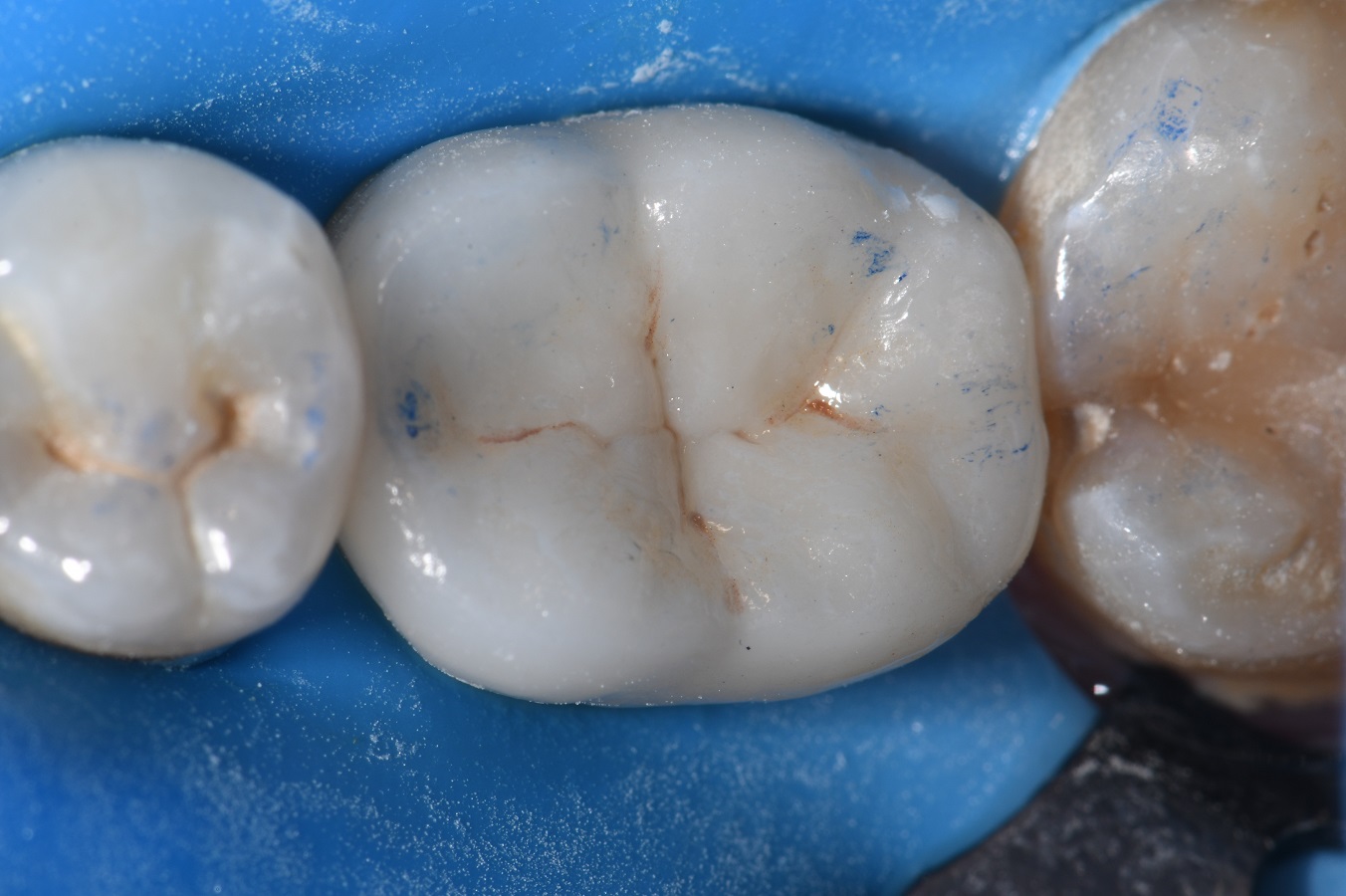 Implant Screw Access Closure using Composite Resin