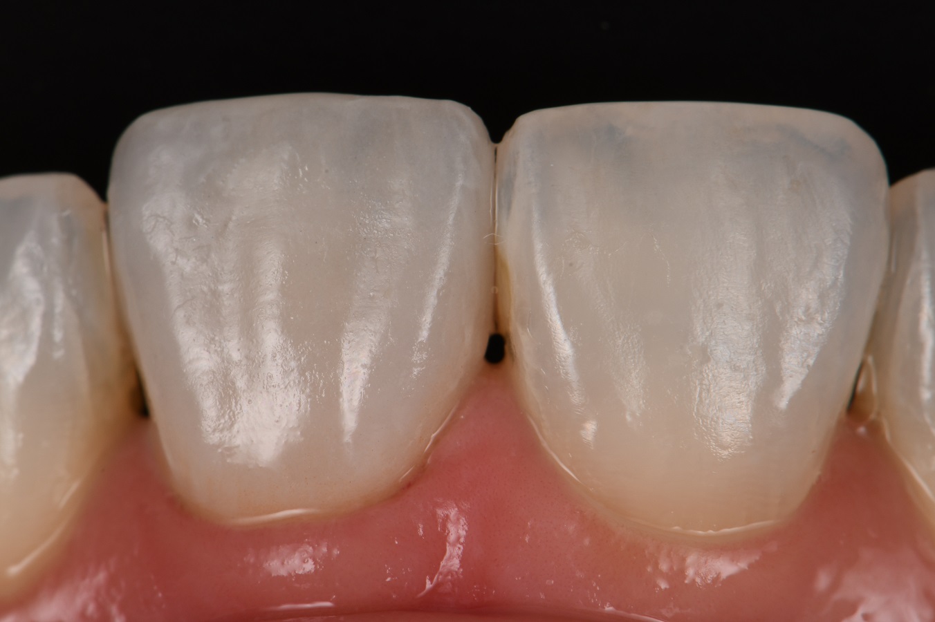 Single porcelain veneer to match natural teeth