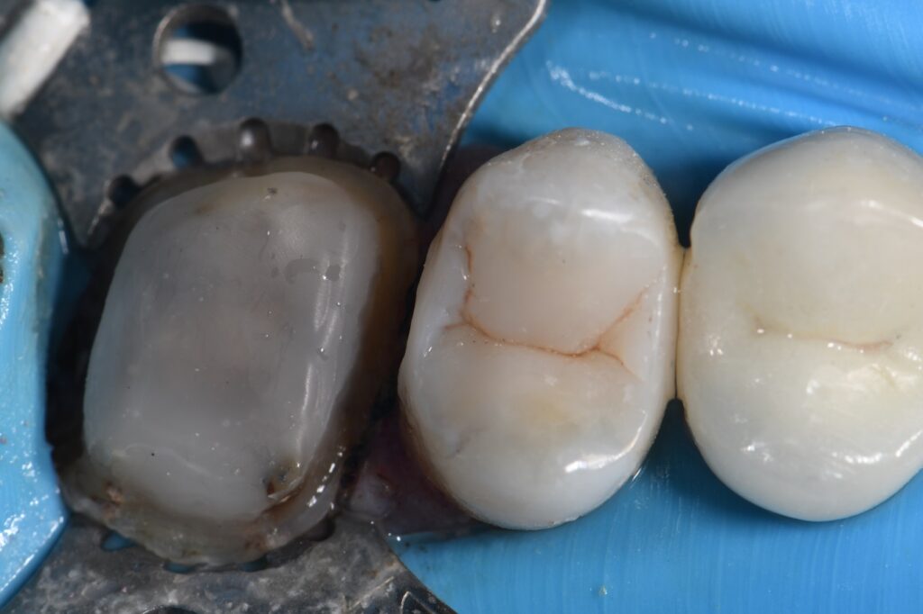 Extreme core buildups