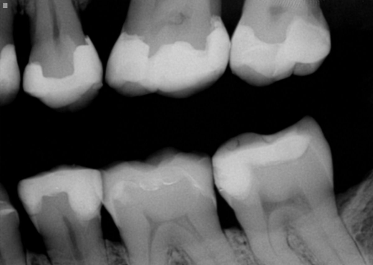 Matrix in Matrix Composite Reconstruction of Second Molar