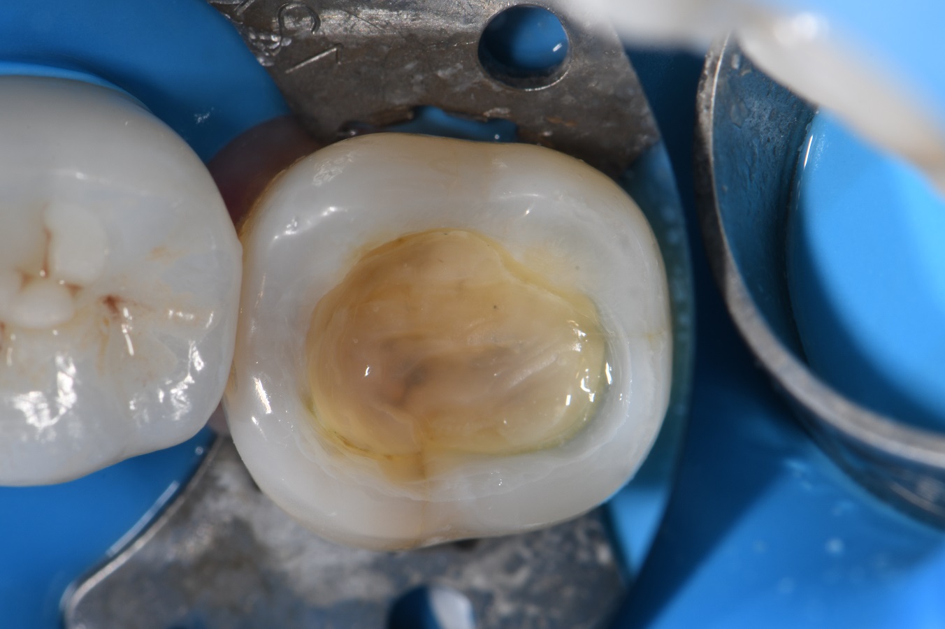 Supercomposite Class I restoration