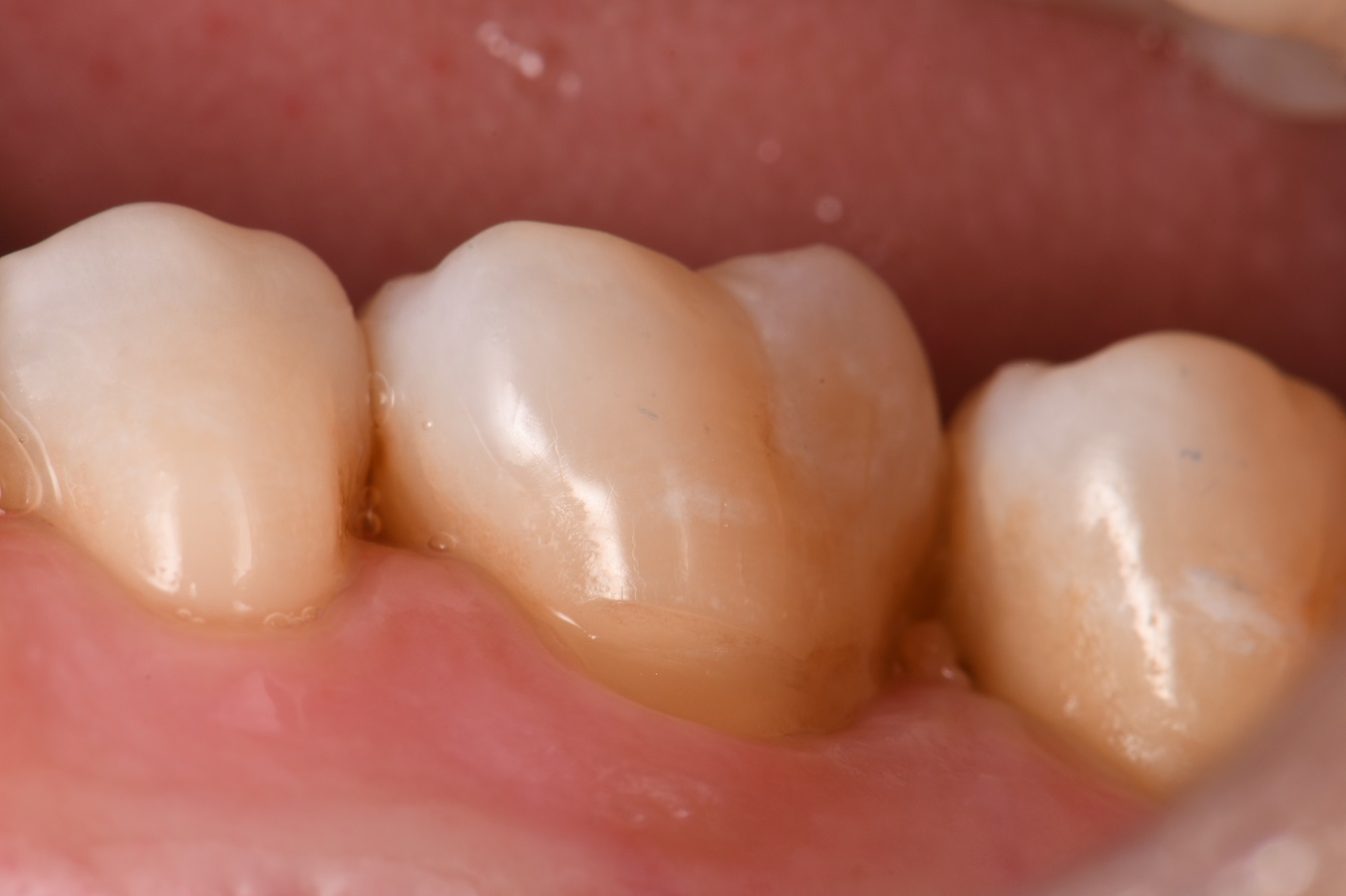 How to Design Class V root composite restorations
