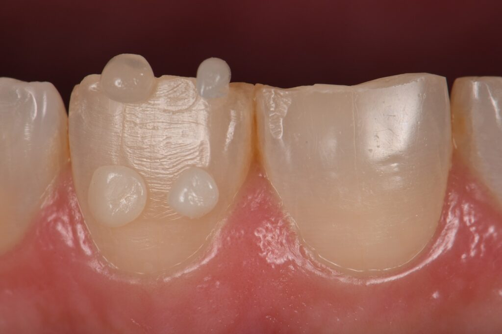 Edge Bonding with Composite Resin