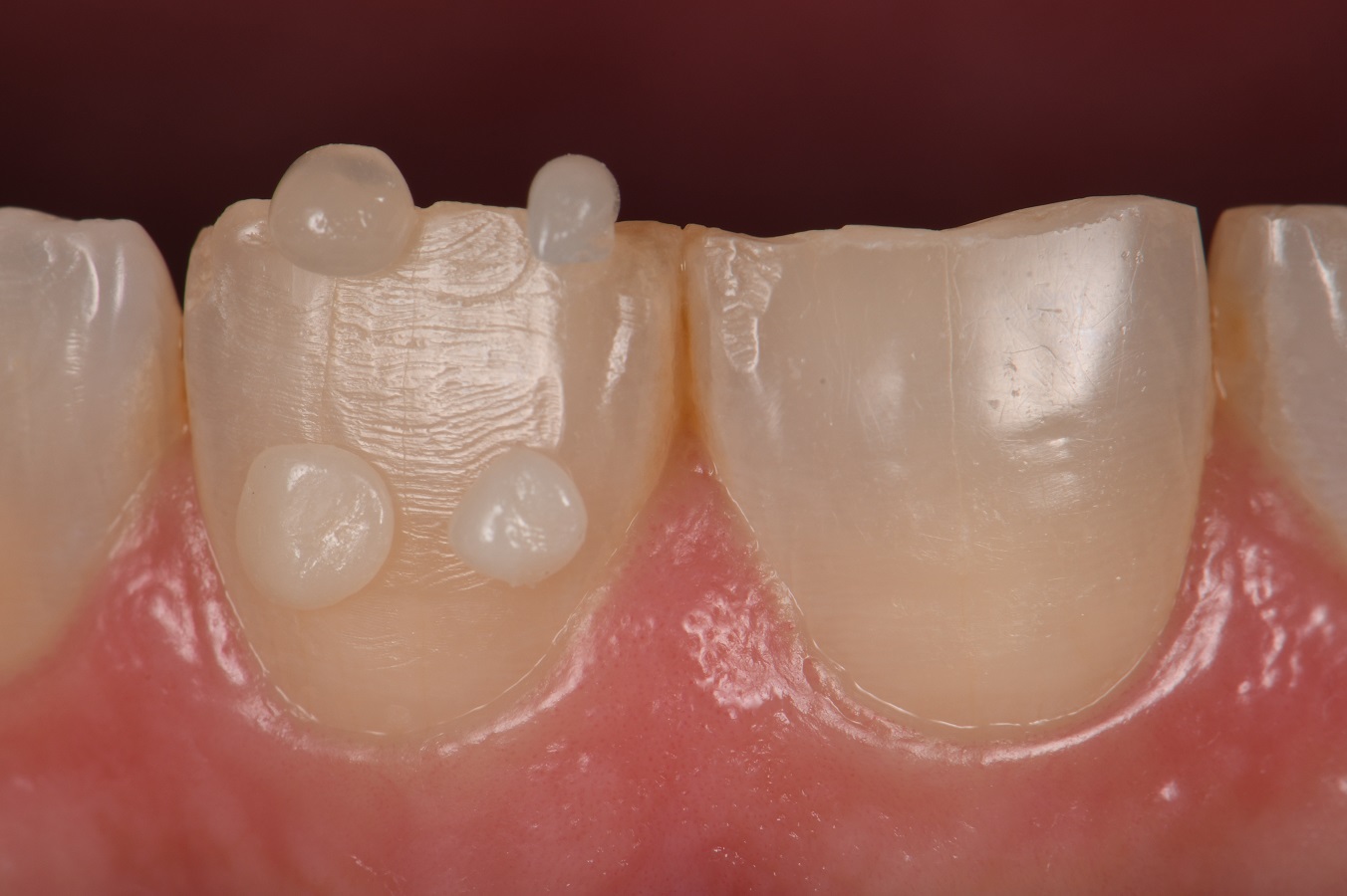 Edge Bonding with Composite Resin