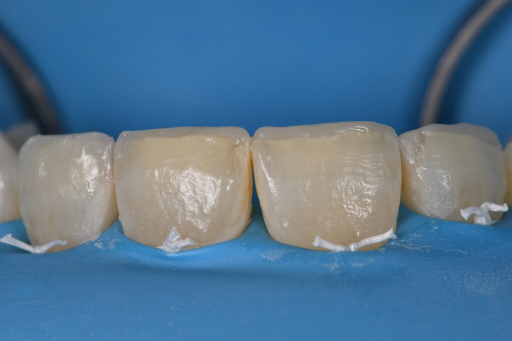 Edge Bonding with Composite Resin