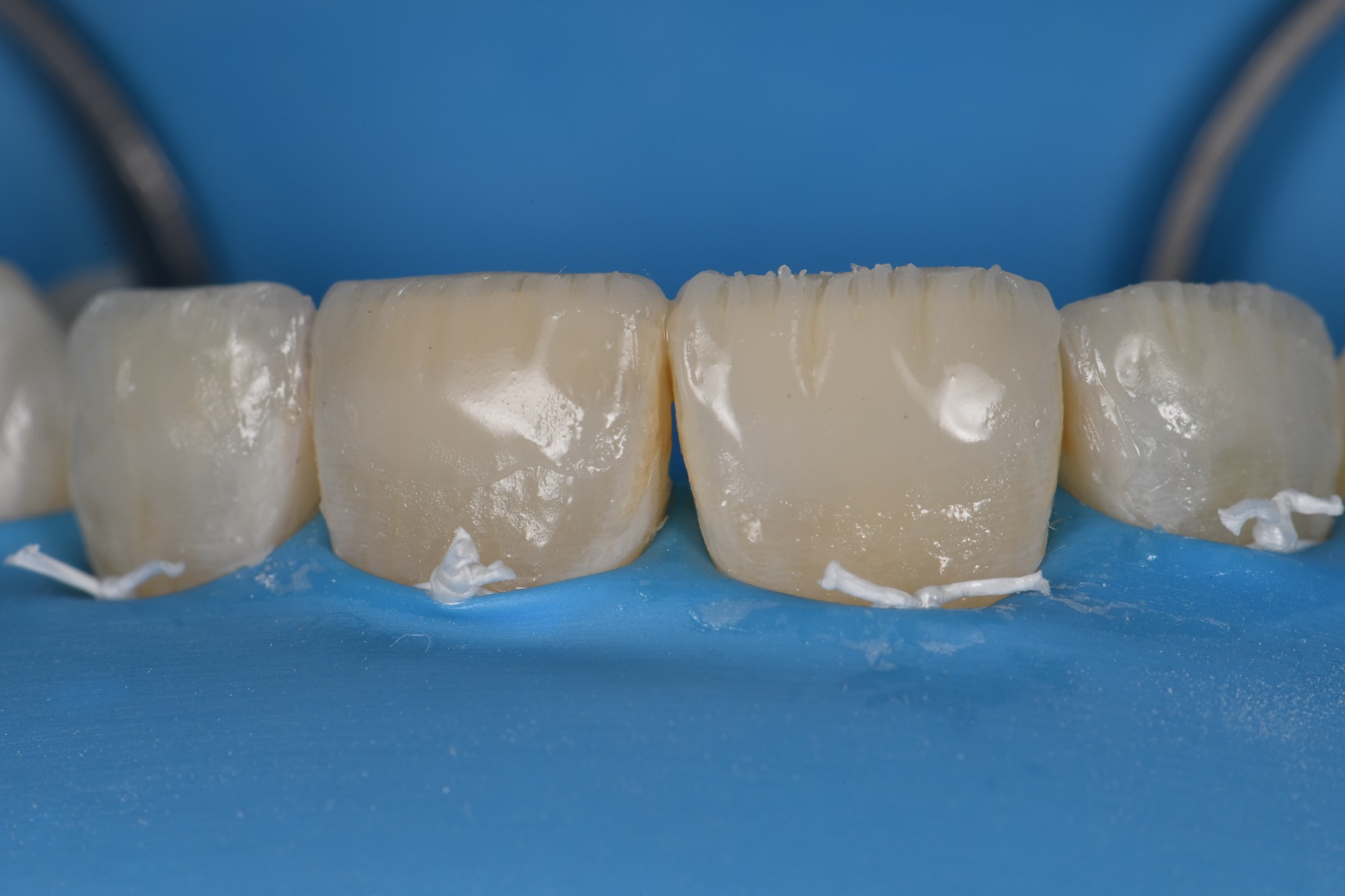 Edge Bonding with Composite Resin