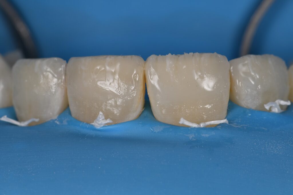 Edge Bonding with Composite Resin