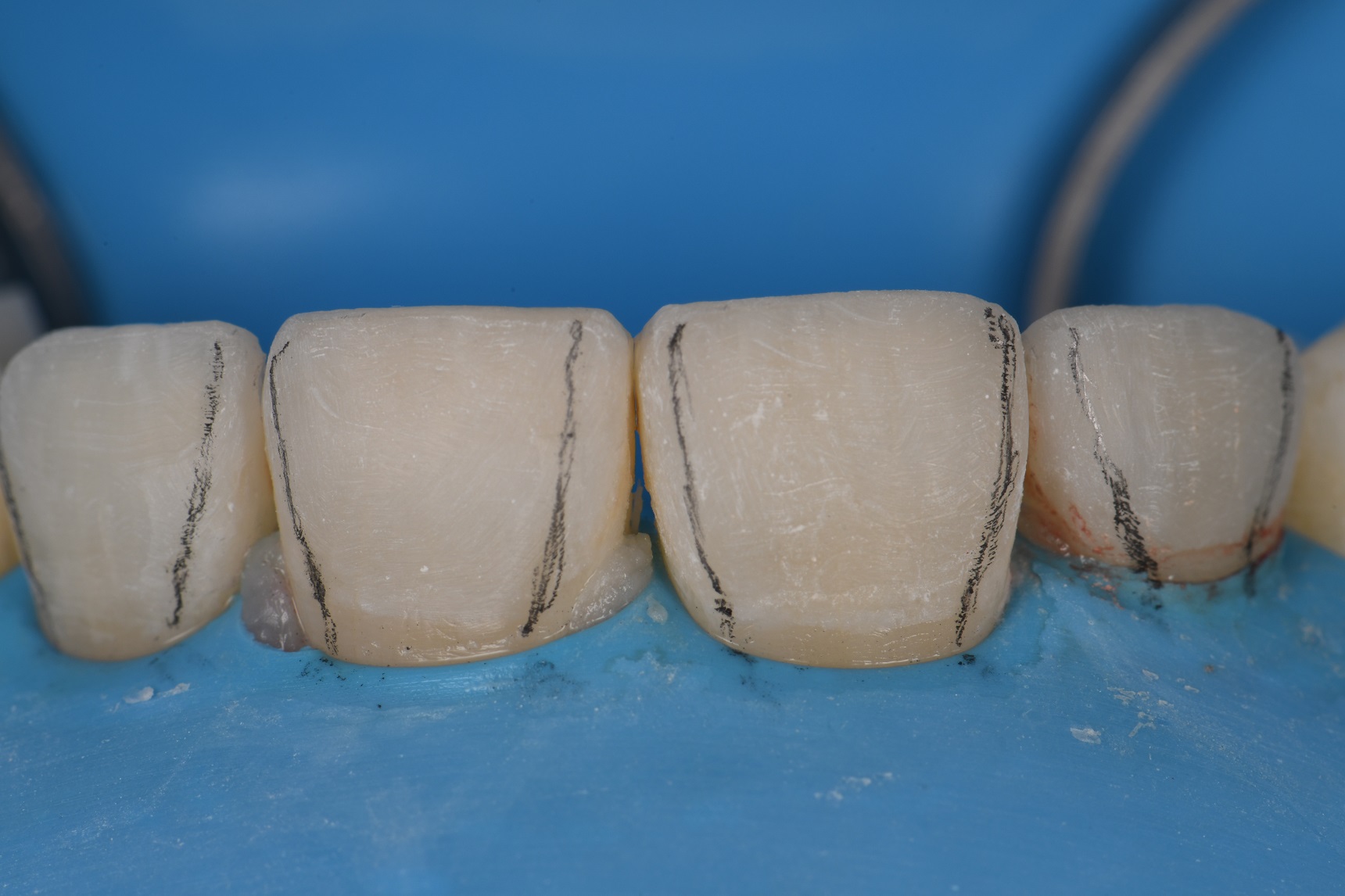 Edge Bonding with Composite Resin