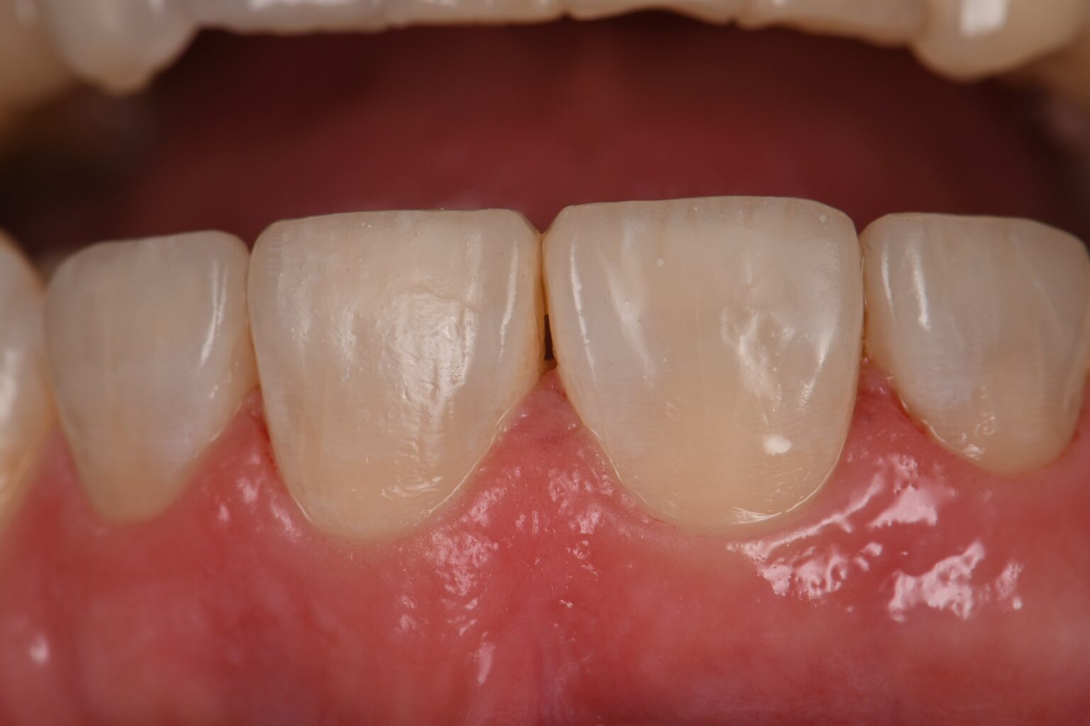 Edge Bonding with Composite Resin