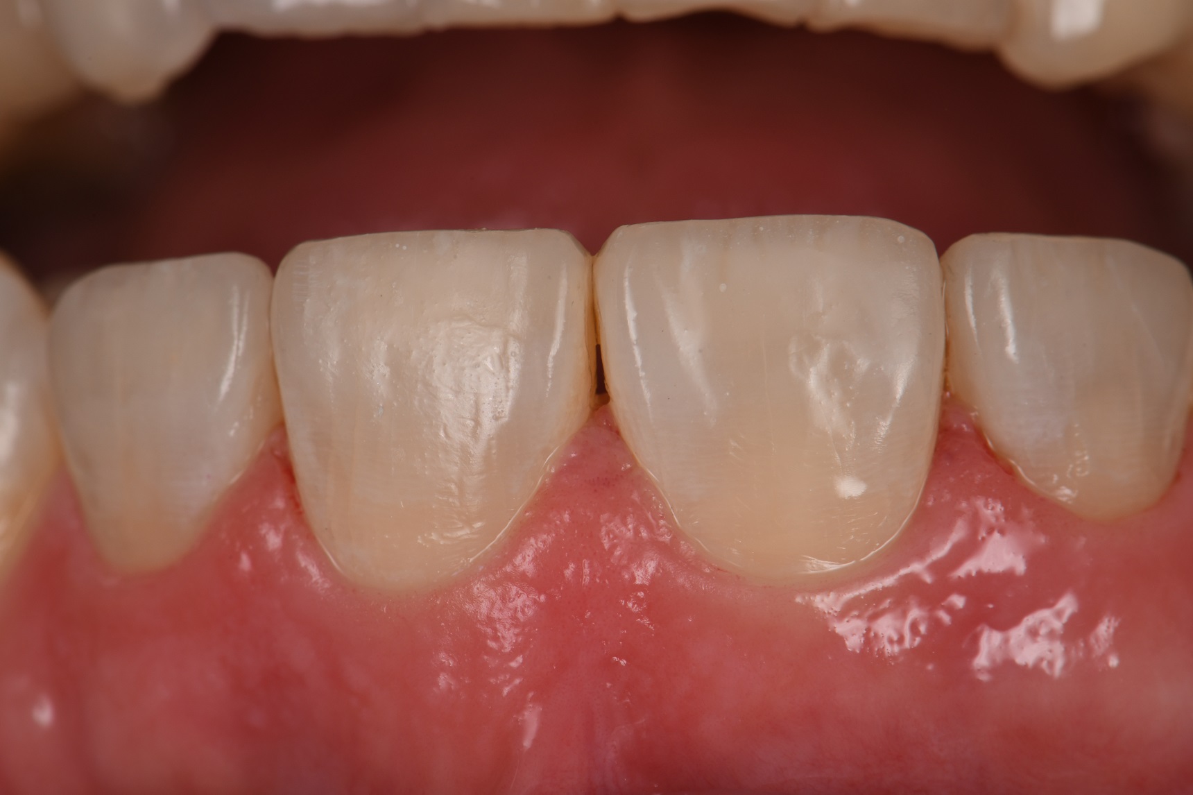 Edge Bonding with Composite Resin