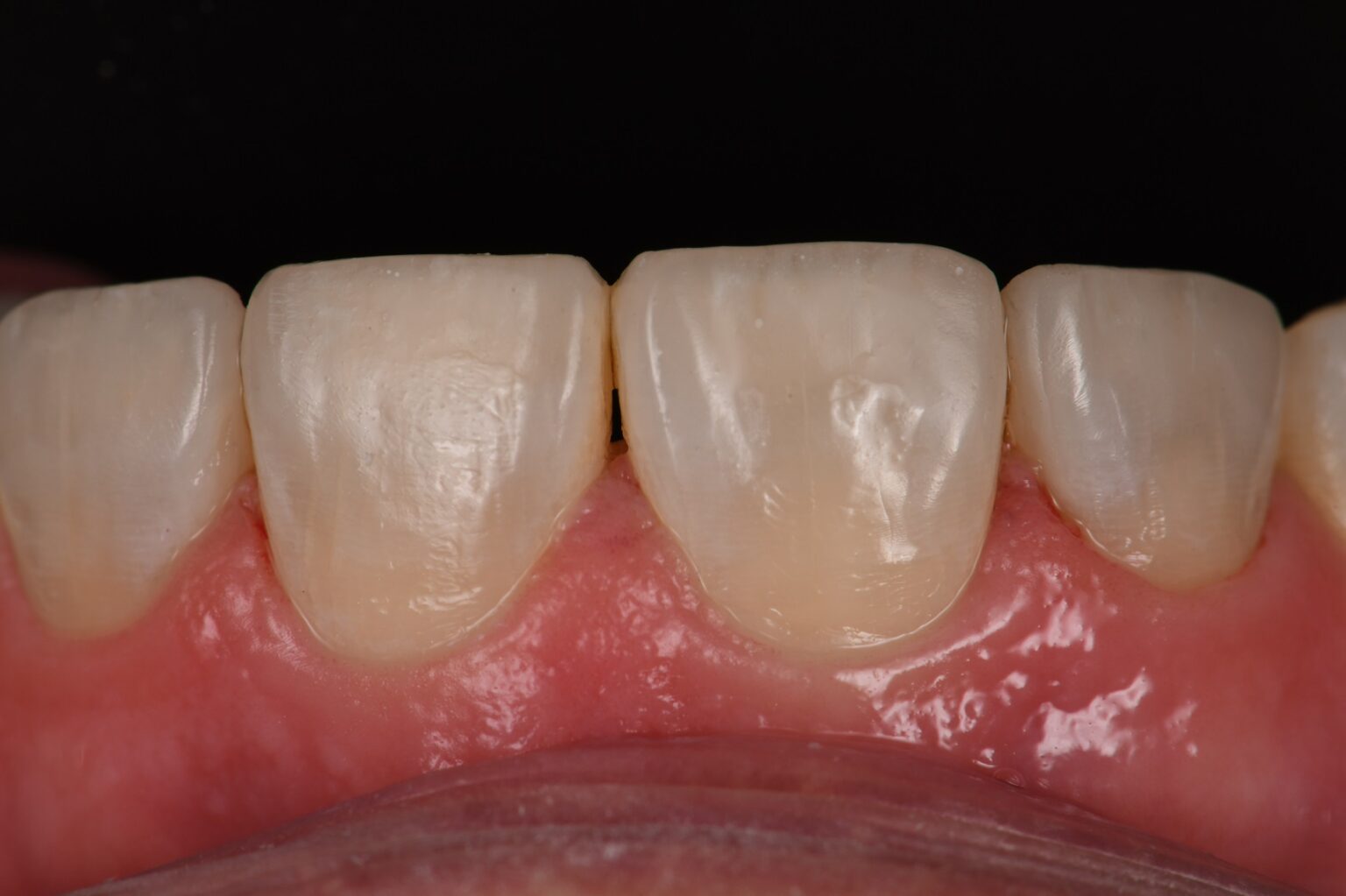 Edge Bonding with Composite Resin