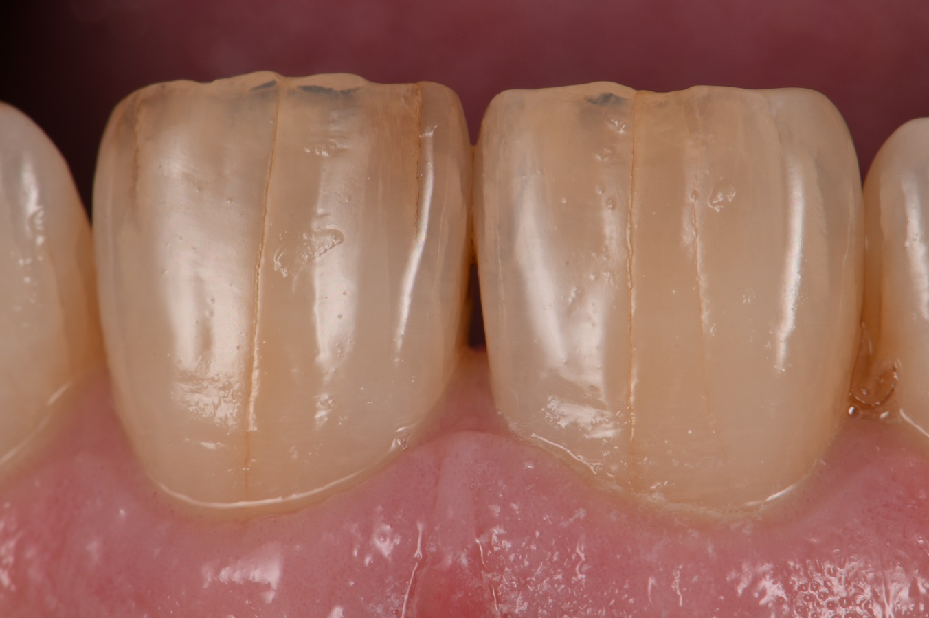 How to treat Vertical Cracks in a front tooth