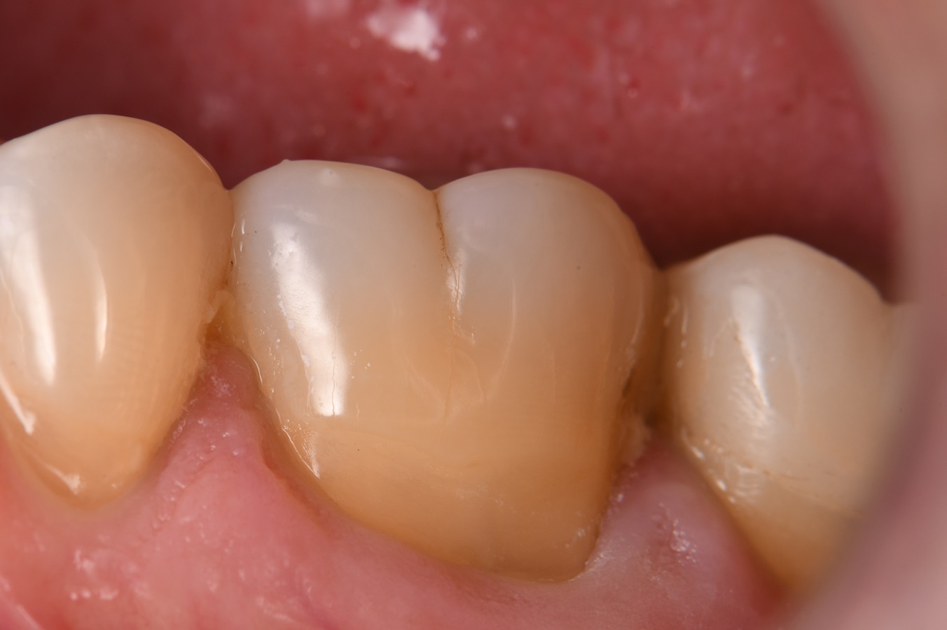How to Design Root Composite Restorations