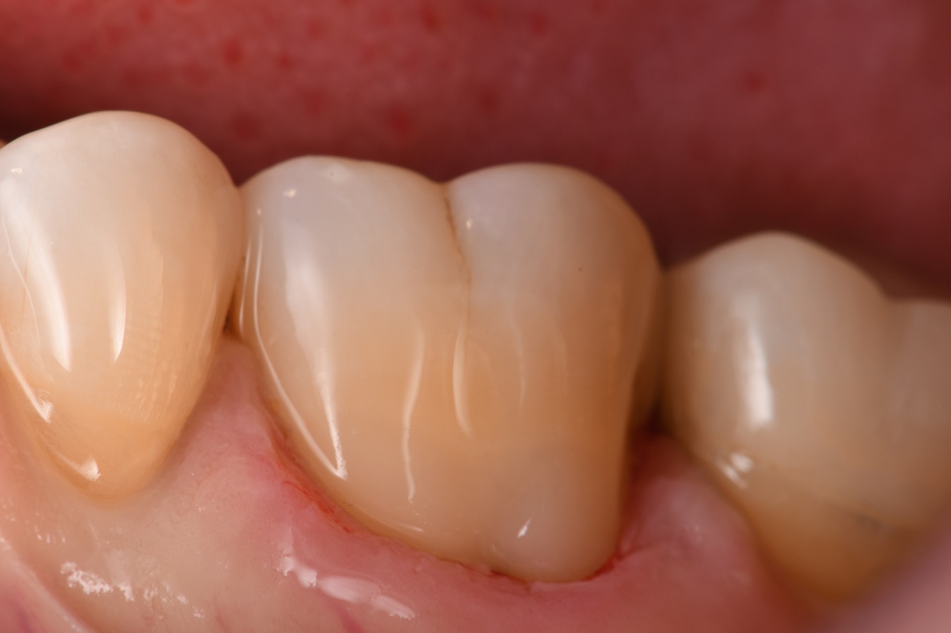 How to Design Root Composite Restorations