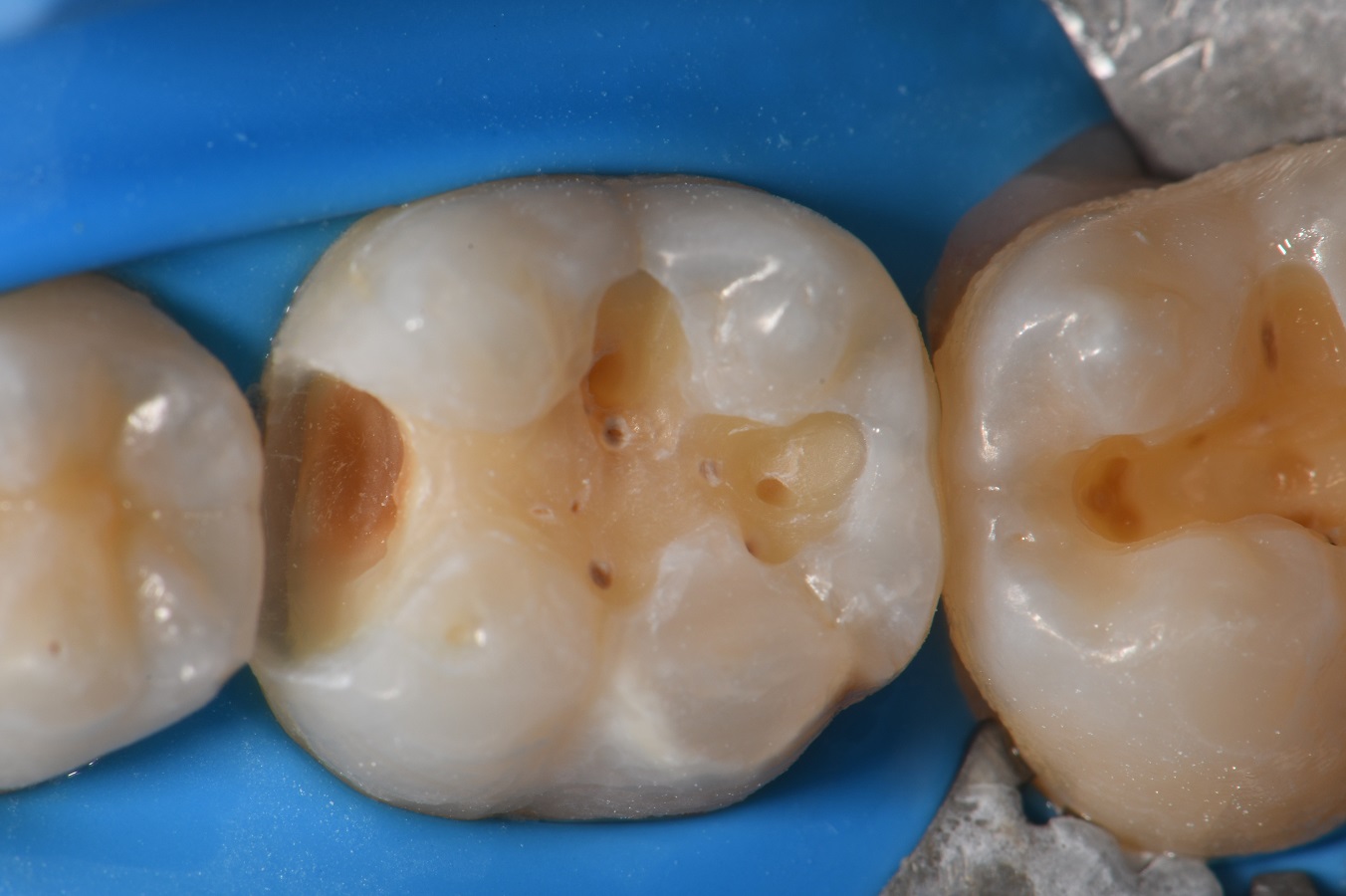 Back to back composite restorations with Voco Grandio SO