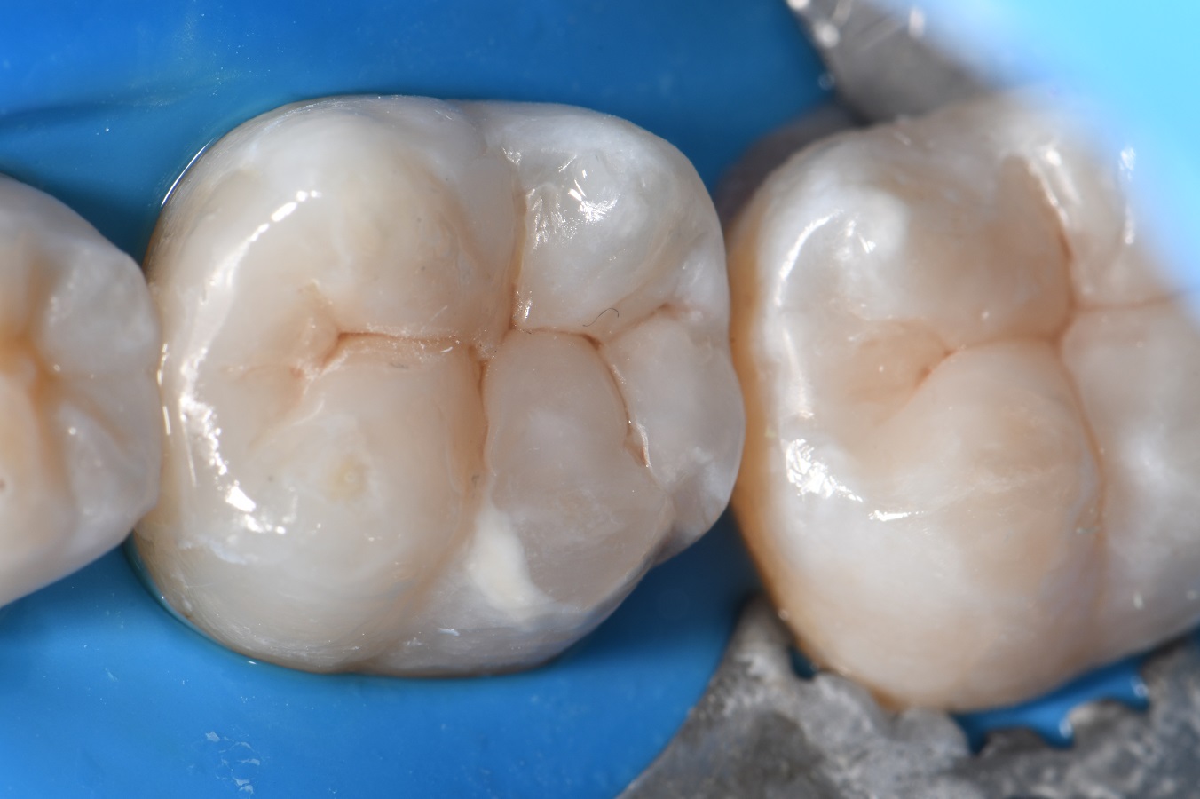 Back to back composite restorations with Voco Grandio SO