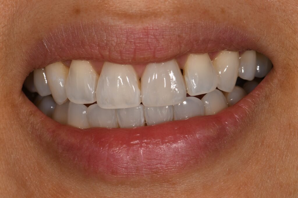 Tricks to Matching a Single Porcelain Veneer