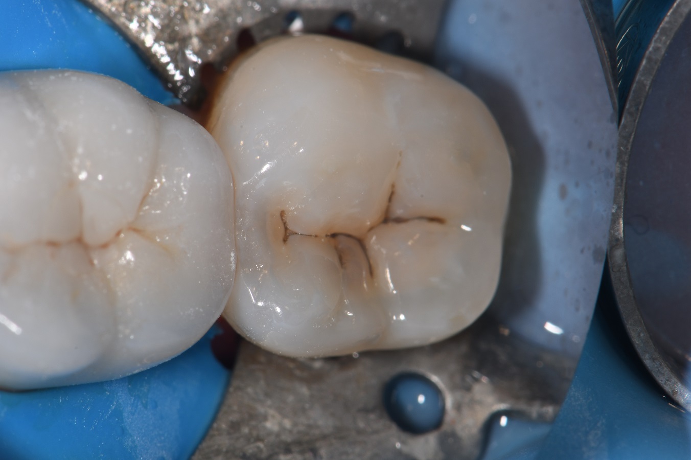 Fissurotomy driven caries removal