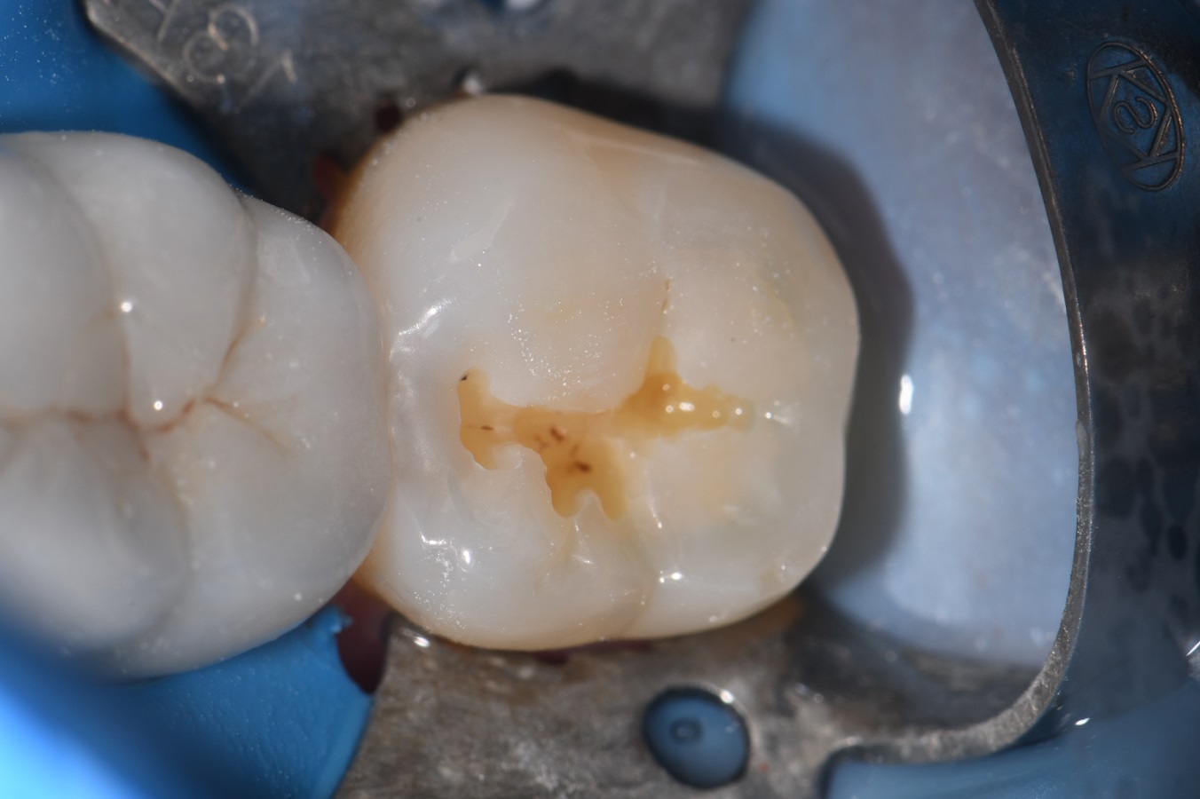 Fissurotomy driven caries removal