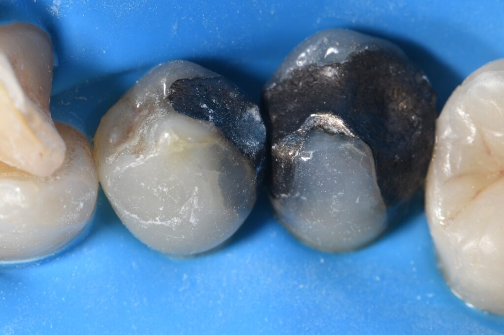 Linguoverted bicuspids heavily restored with amalgams revitalized
