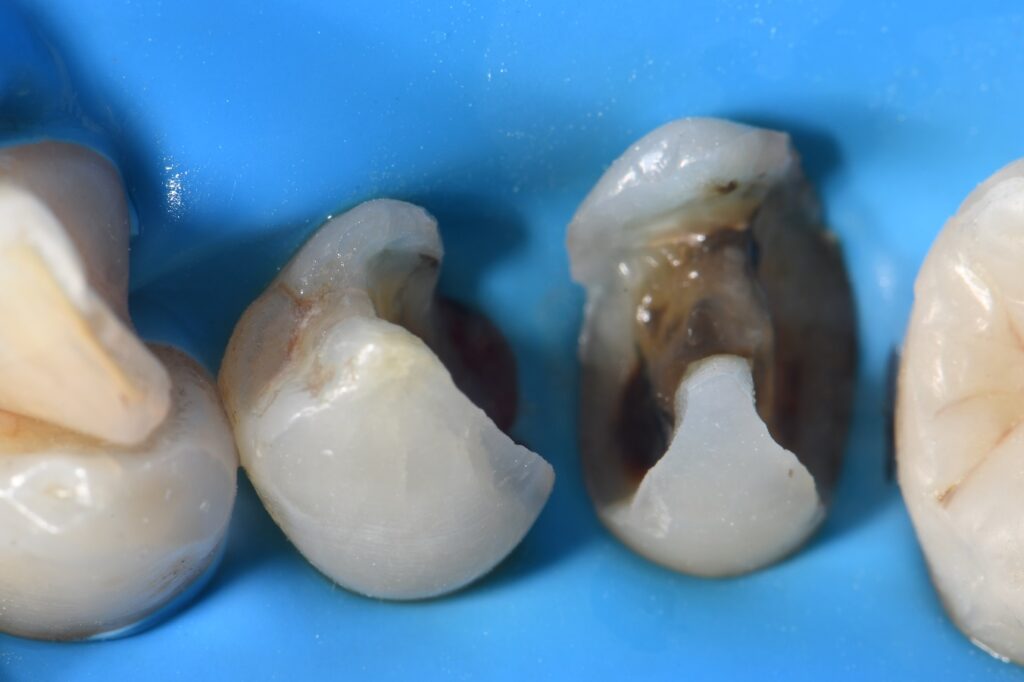 Linguoverted bicuspids heavily restored with amalgams revitalized
