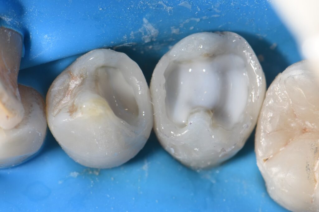 Linguoverted bicuspids heavily restored with amalgams revitalized