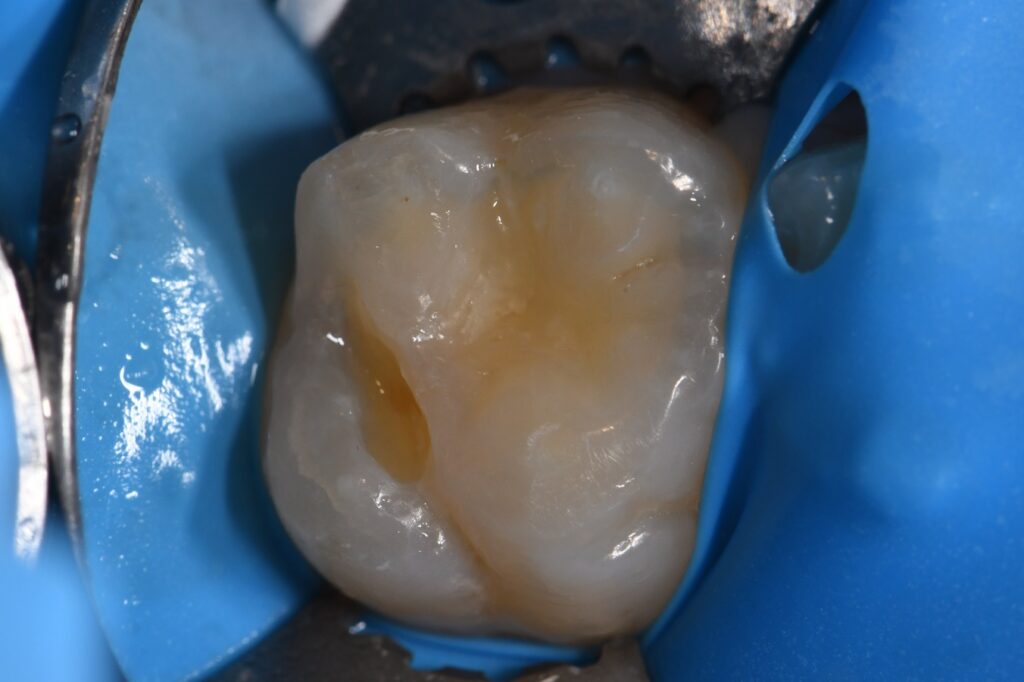 Posterior Molar Esthetics