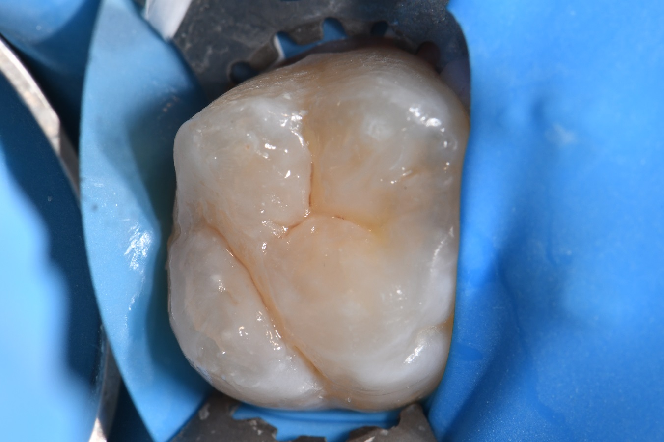 Posterior Molar Esthetics