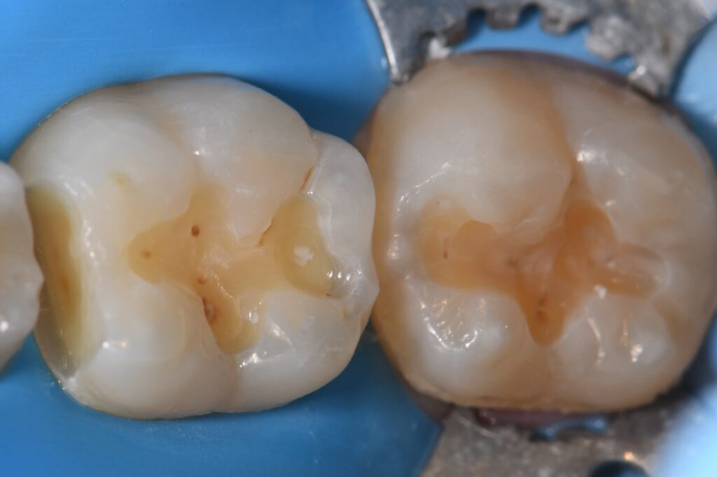 Making Molars look natural with composite