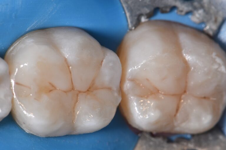 Making Molars look natural with composite