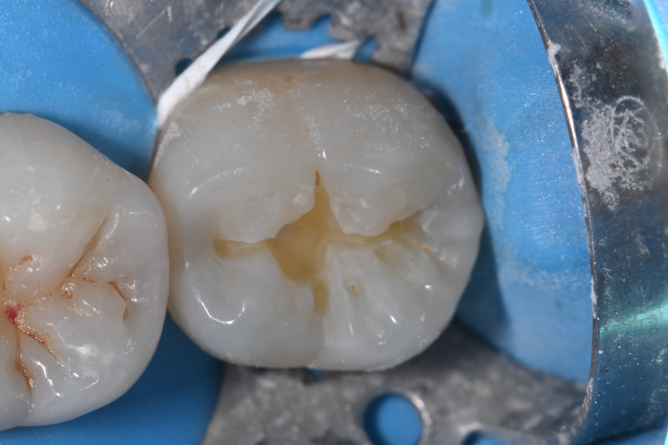 Fissurotomy and Restoration Replacement on a Molar
