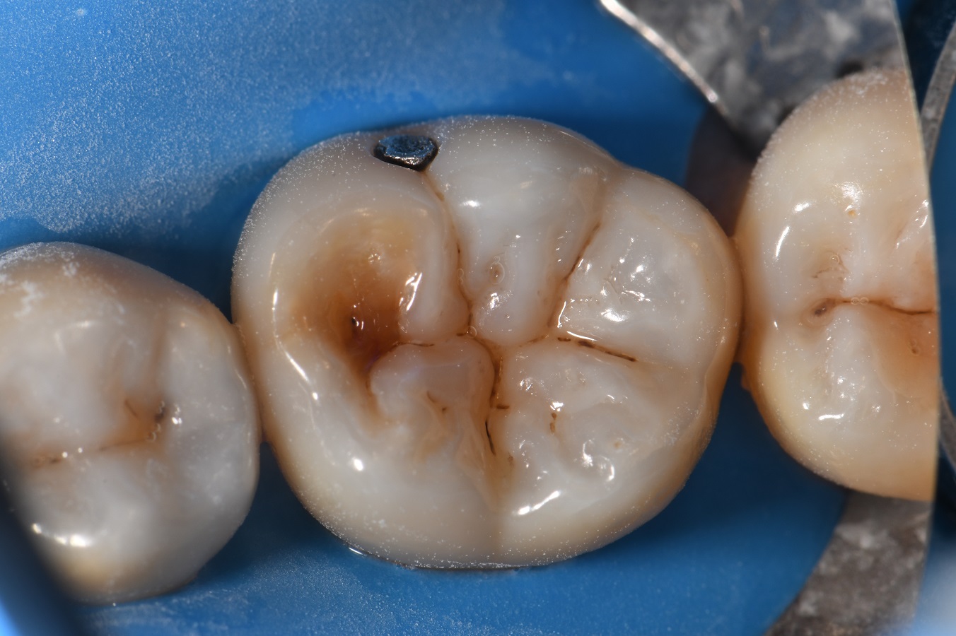 Restoration of Molar Hypomineralization and old Amalgam
