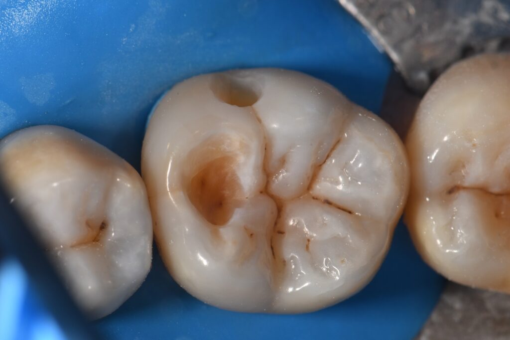 Restoration of Molar Hypomineralization and old Amalgam