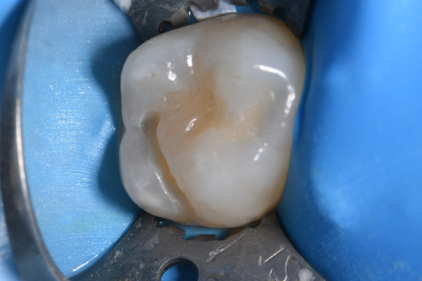 Mimicking Nature even with conservative composite resin