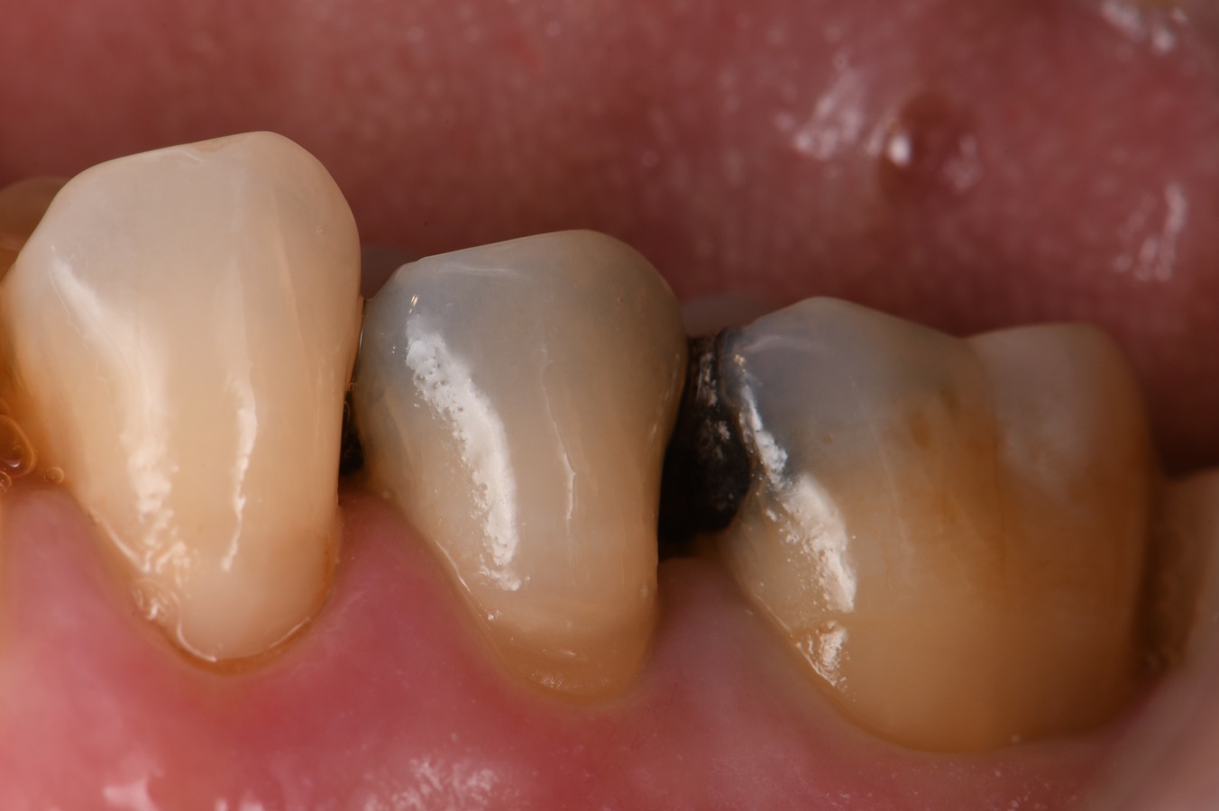 Conservative Class V restorations