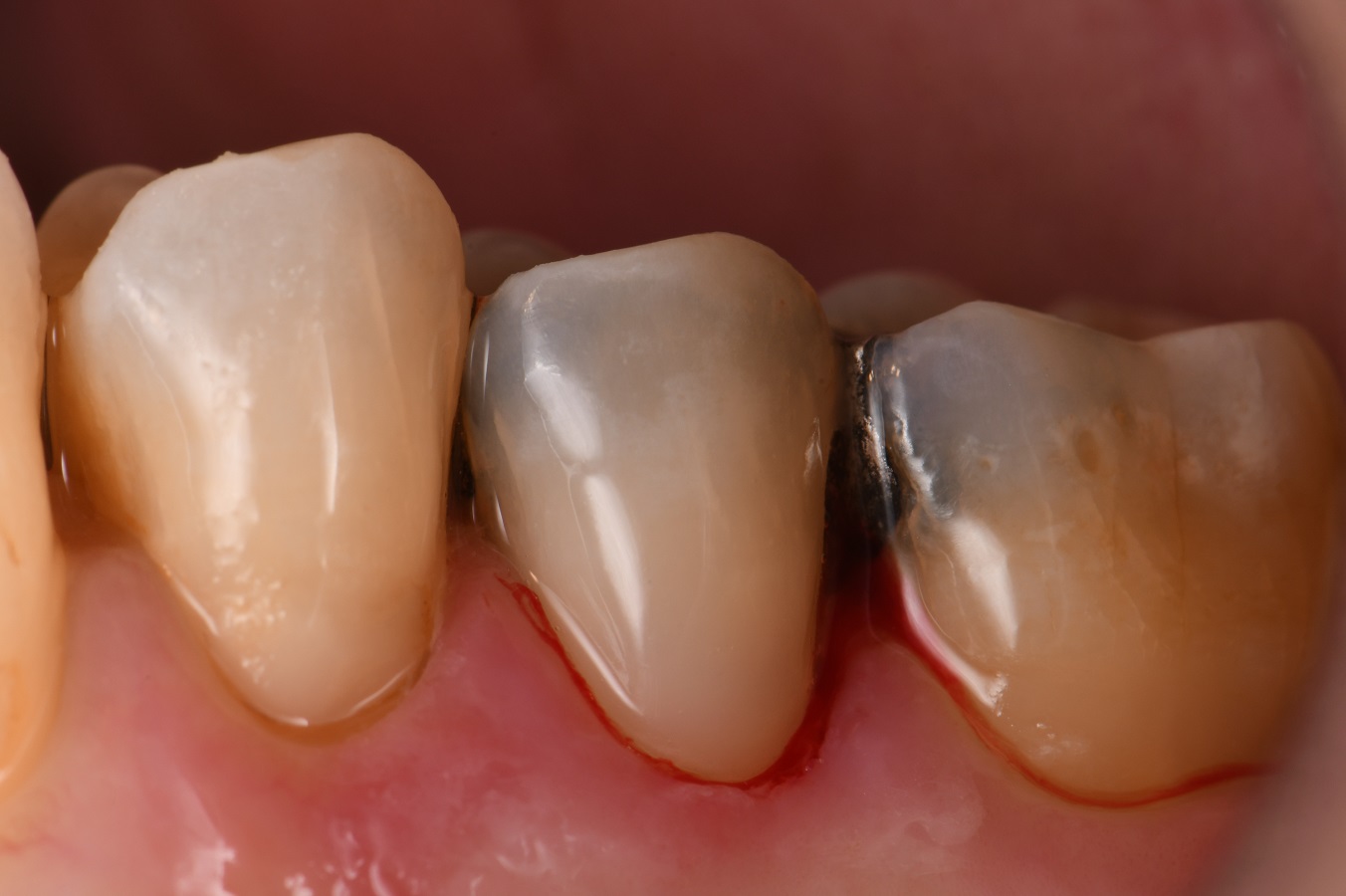 Conservative Class V restorations