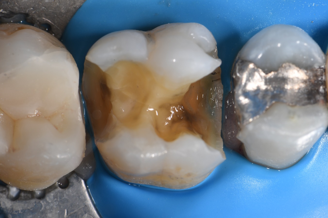 Kuraray Majesty ES2 Universal and DC Core Plus used together