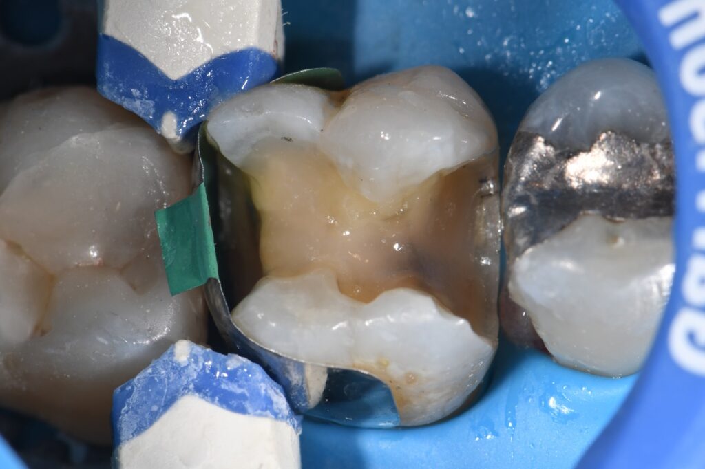 Kuraray Majesty ES2 Universal and DC Core Plus used together