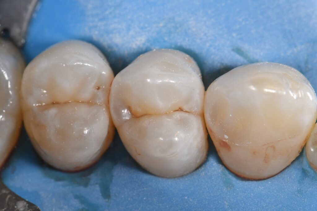 Slot composite restoration using a supercomposite