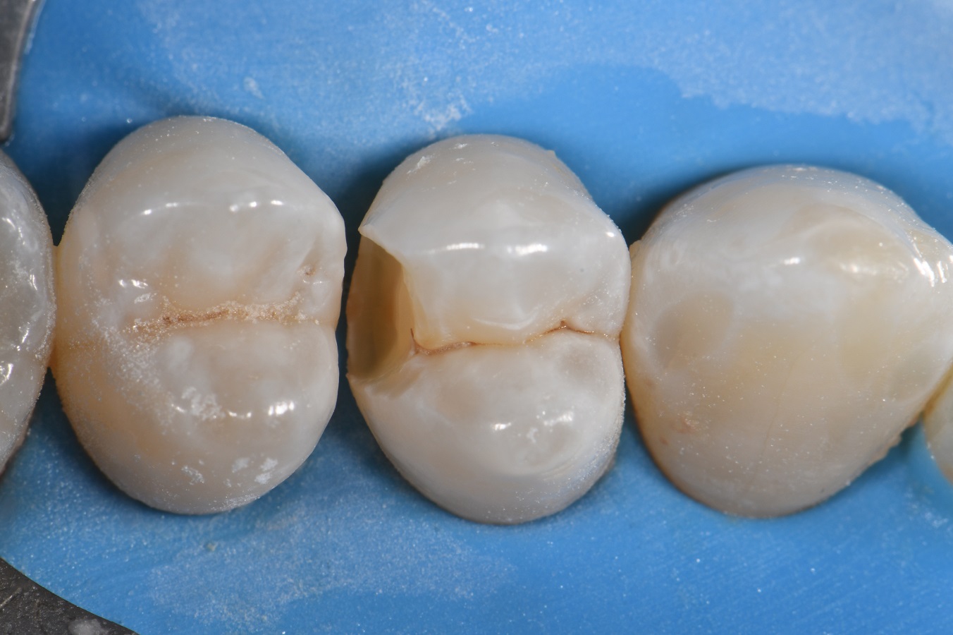 Slot composite restoration using a supercomposite