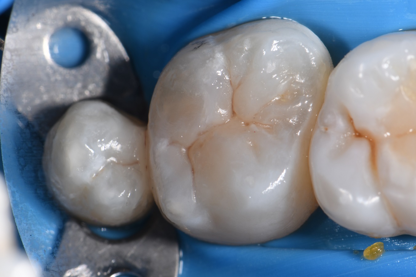 Isolating a Peg Molar for a Dental Cavity