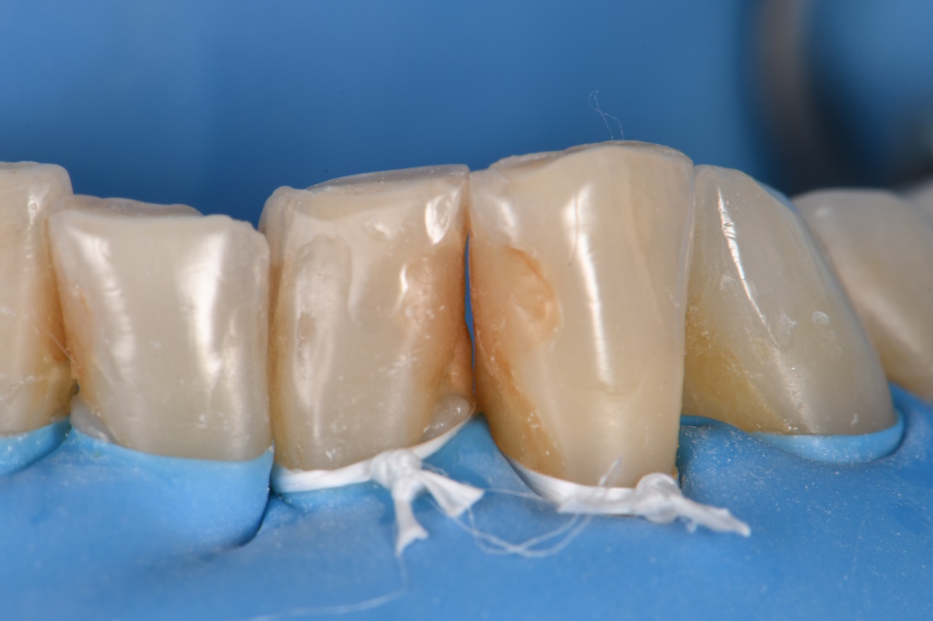 Making Dark Composite Fillings Disappear with Supercomposite material