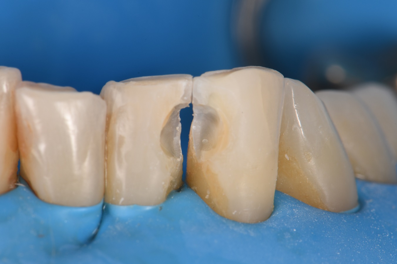 Making Dark Composite Fillings Disappear with Supercomposite material