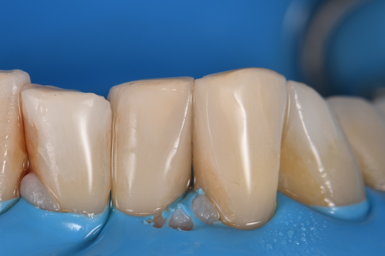 Making Dark Composite Fillings Disappear with Supercomposite material